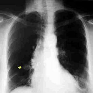 ¿Qué es un nódulo pulmonar? | El Norte de Castilla